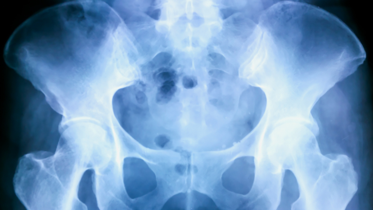 Dolor Pélvico Crónico en hombres: qué es, causas y tratamiento – Mejora Tu Dolor